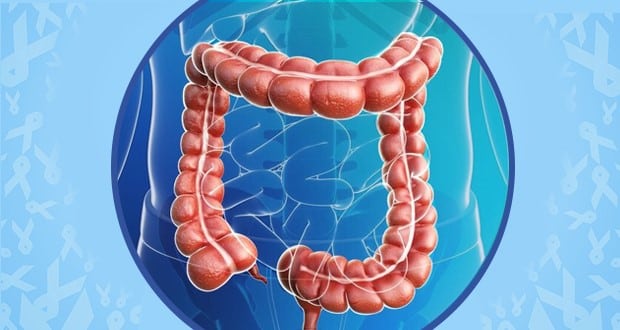 Colorectal Cancer 5 Prevention Tips - HBE Voedingsprogramma tegen kanker